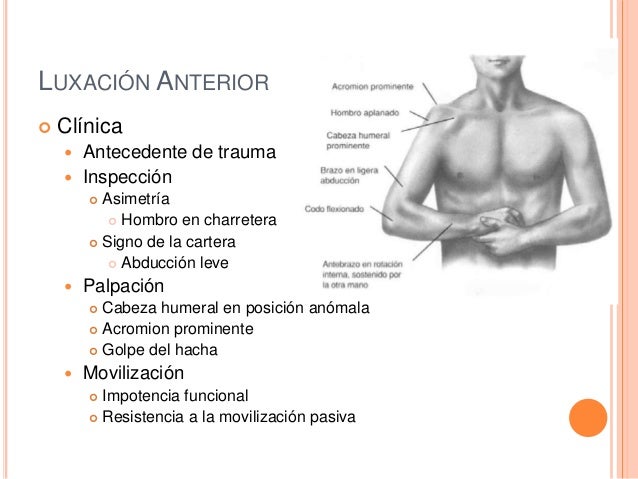 Luxación de hombro
