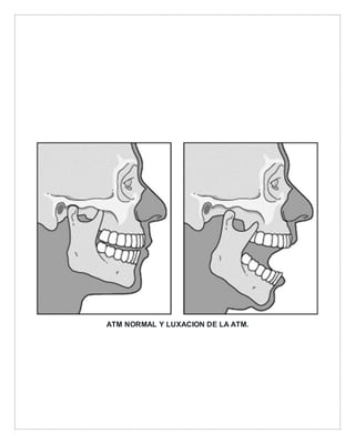 Luxacion de la articulacion temporomandibular (atm) | DOCX