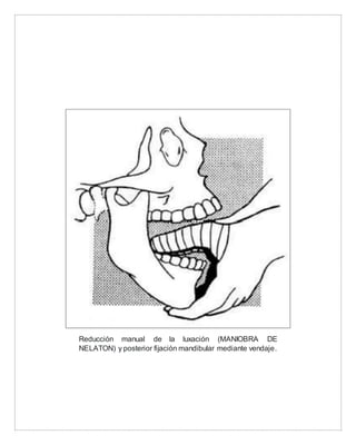 Luxacion de la articulacion temporomandibular (atm) | DOCX