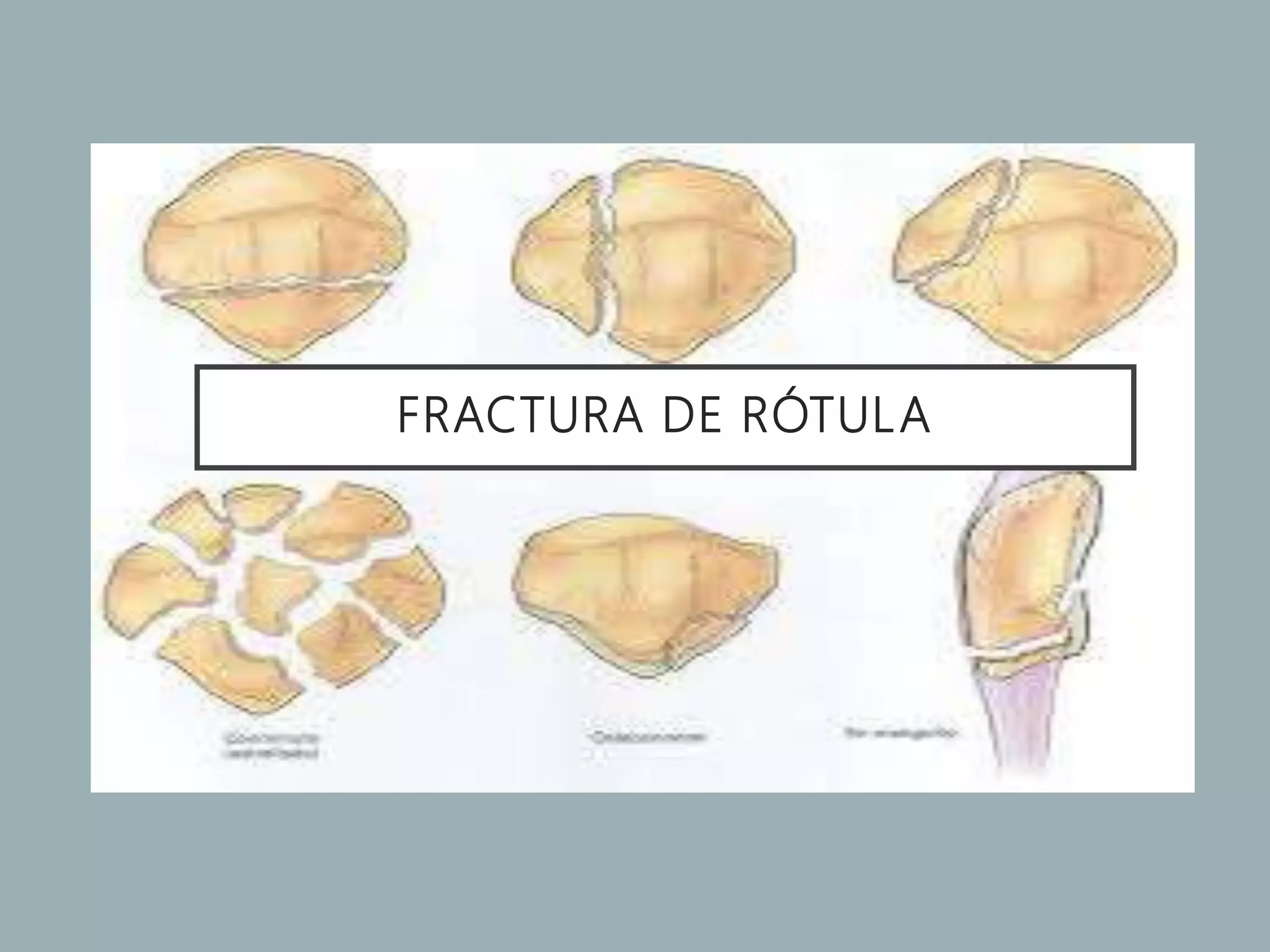 Luxacion de rodilla y fractura de rotula | PPTX