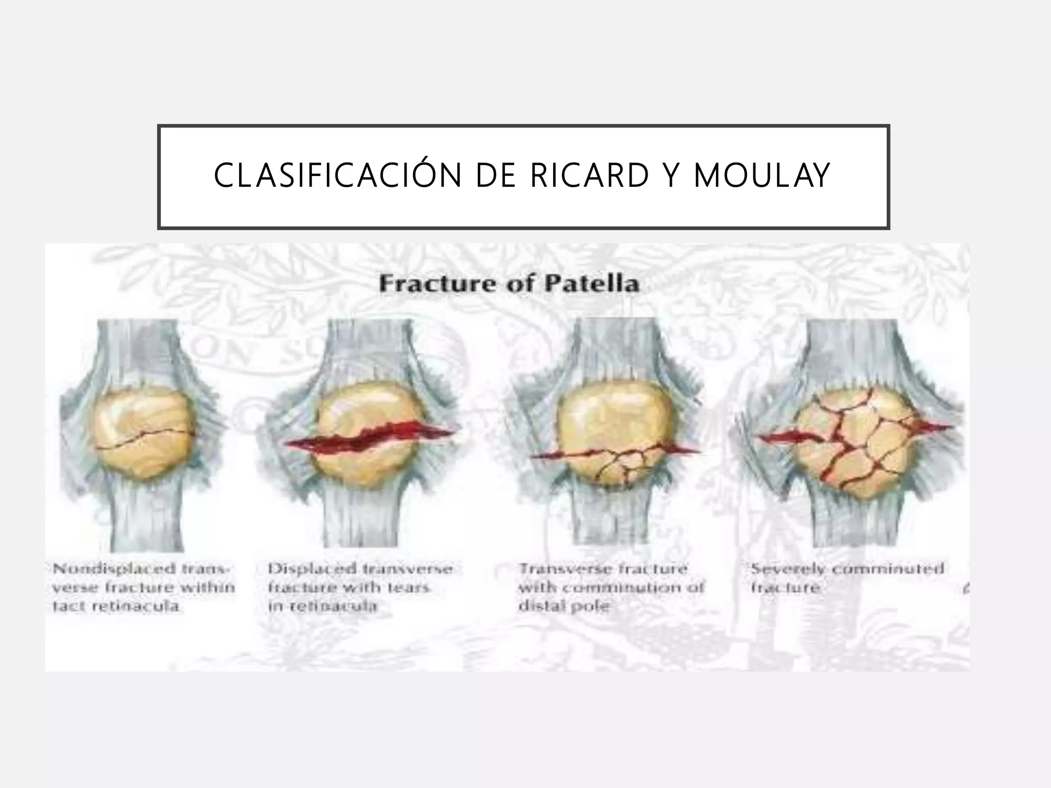 Luxacion de rodilla y fractura de rotula | PPT