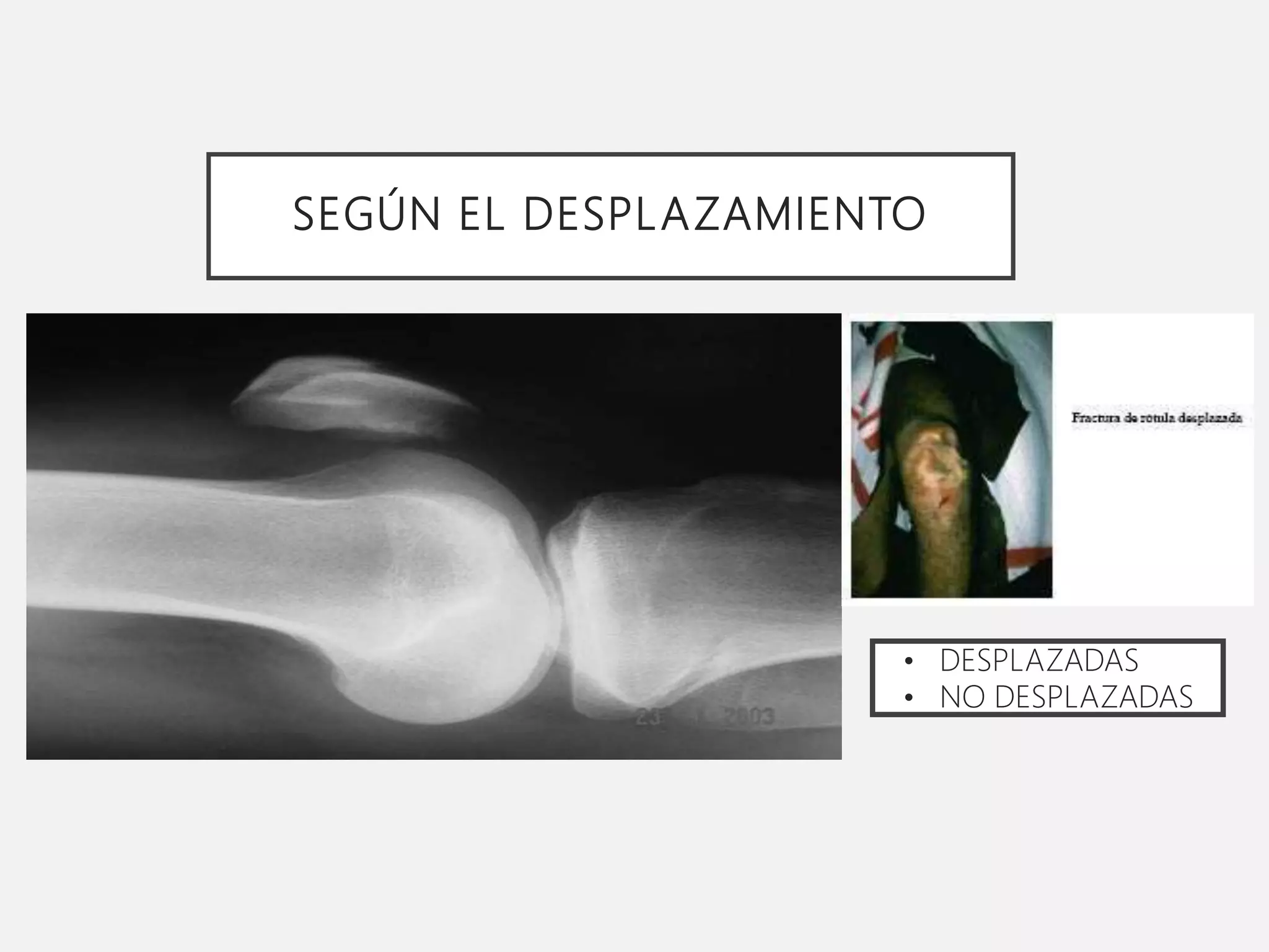 Luxacion de rodilla y fractura de rotula | PPTX