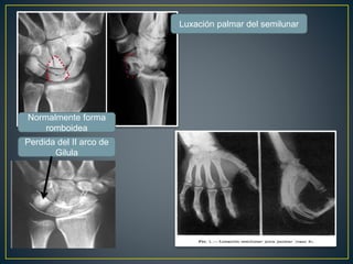 Luxaciones del carpo | PPTX