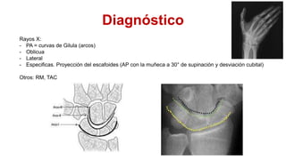 luxaciones y fracturas de carpo TRAUMA.ppt