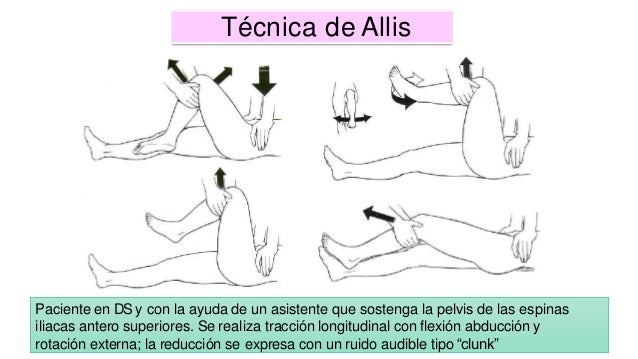 Luxacion traumatica de cadera