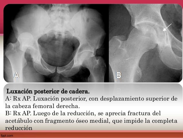 Luxacion traumatica de cadera