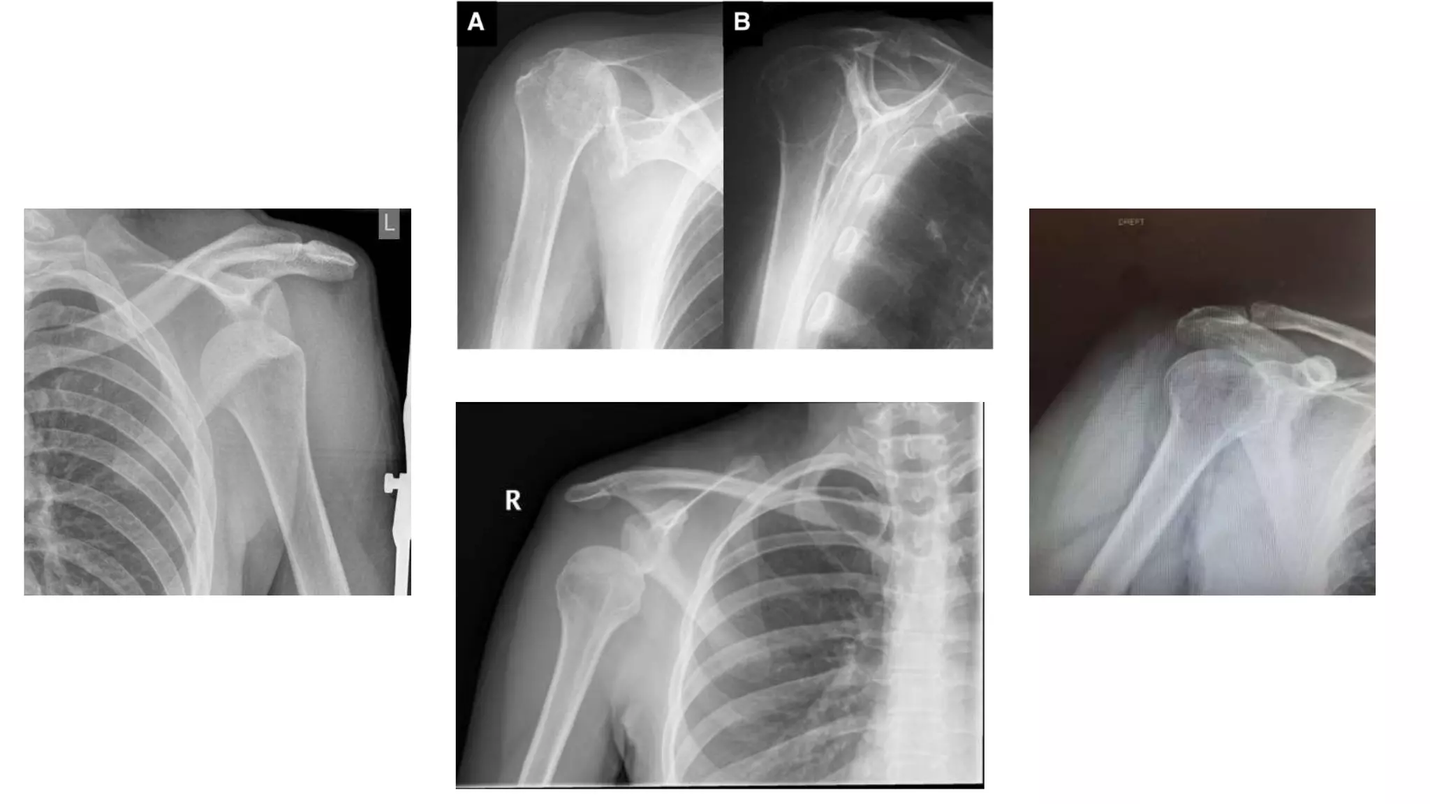 Luxatia scapula-humerala.pptx