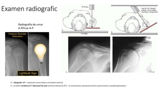 Luxatia scapula-humerala.pptx