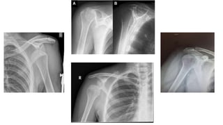 Luxatia scapula-humerala.pptx