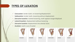 LUXATION injury of tmj with mouth and jaw | PPT
