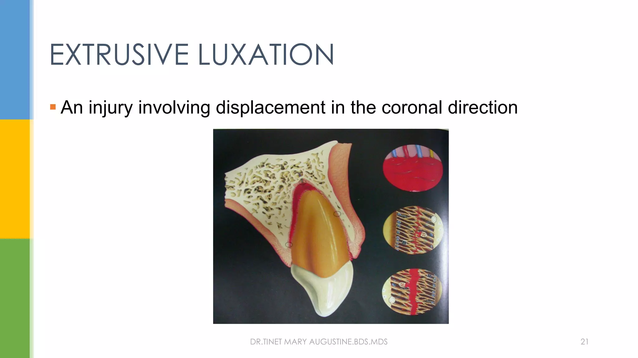 Luxation injuries and avulsion | PDF