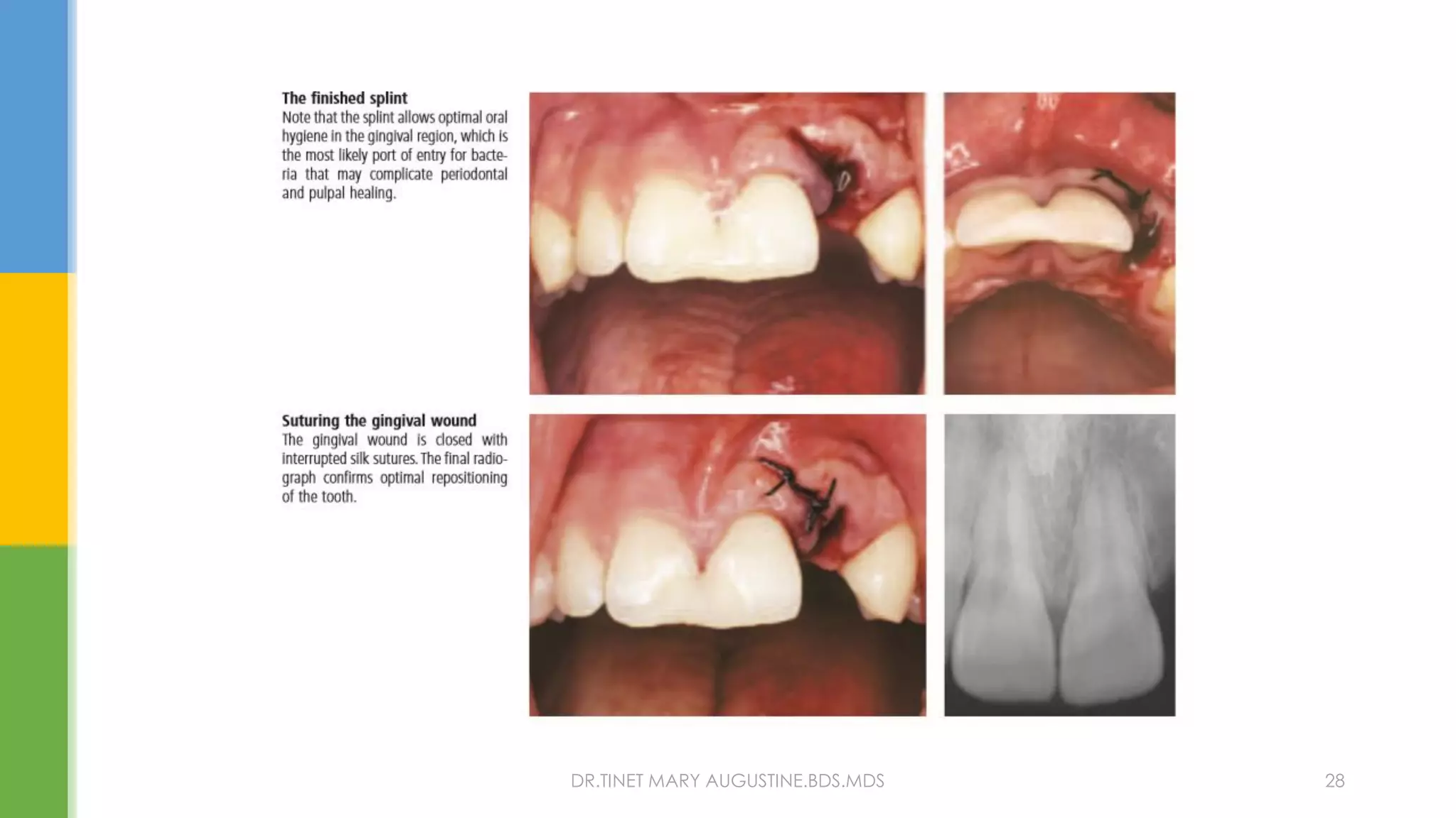 Luxation injuries and avulsion | PDF