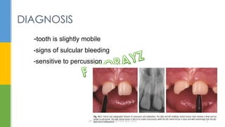 Luxation injuries and avulsion | PDF