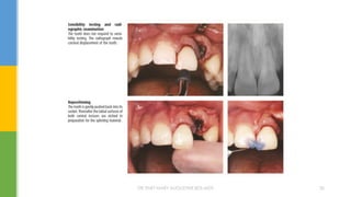 Luxation injuries and avulsion | PDF