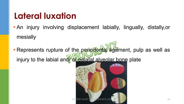 Luxation injuries and avulsion | PDF