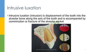 Luxation injuries and avulsion | PDF