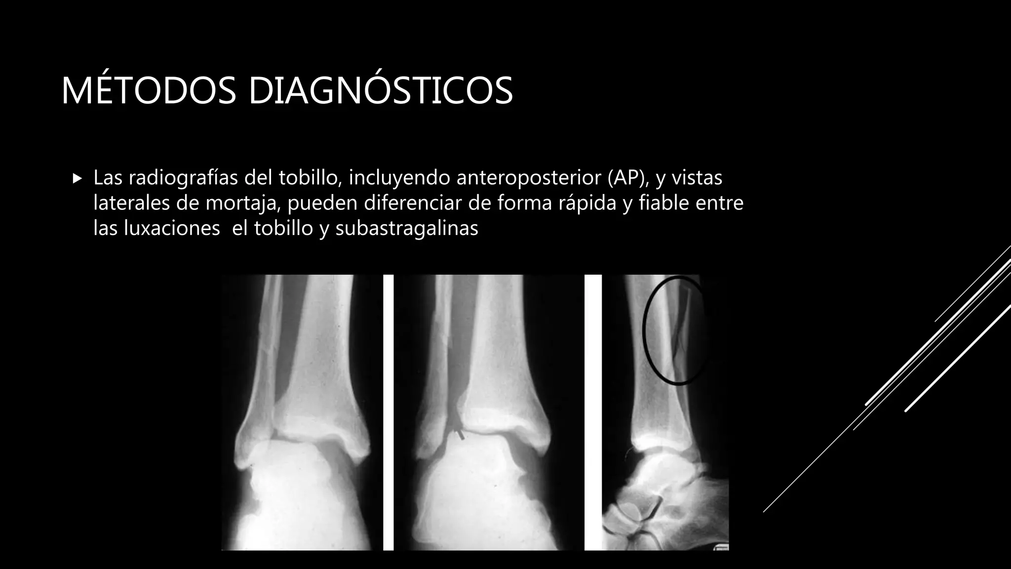 Luxofractura de tobillo | PPTX