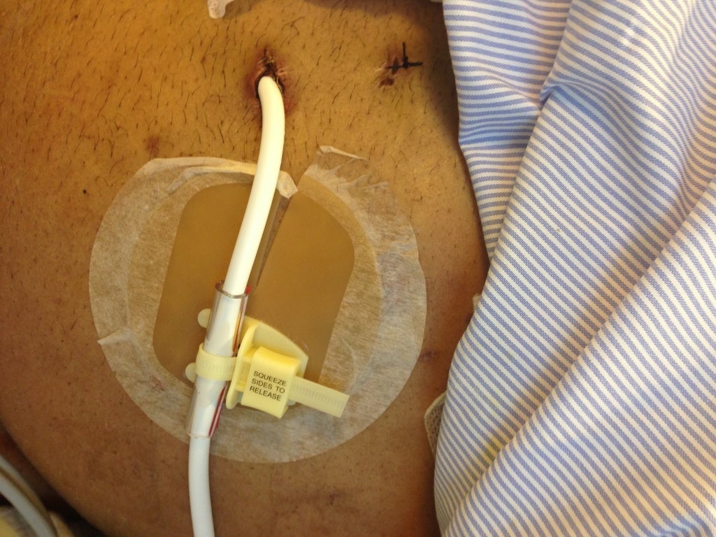 LVAD in India, LVAD Implantation in India, LVAD II Final Output 20/10…