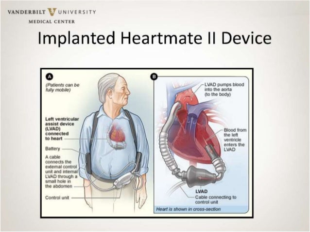 LVAD - Left Ventricular Assist Device