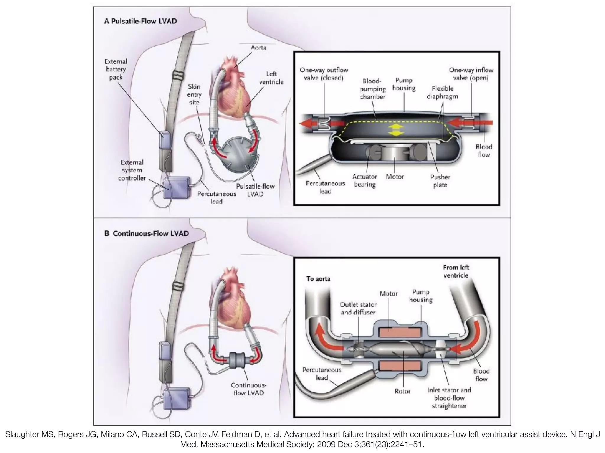 Ventricular assist devices | PDF