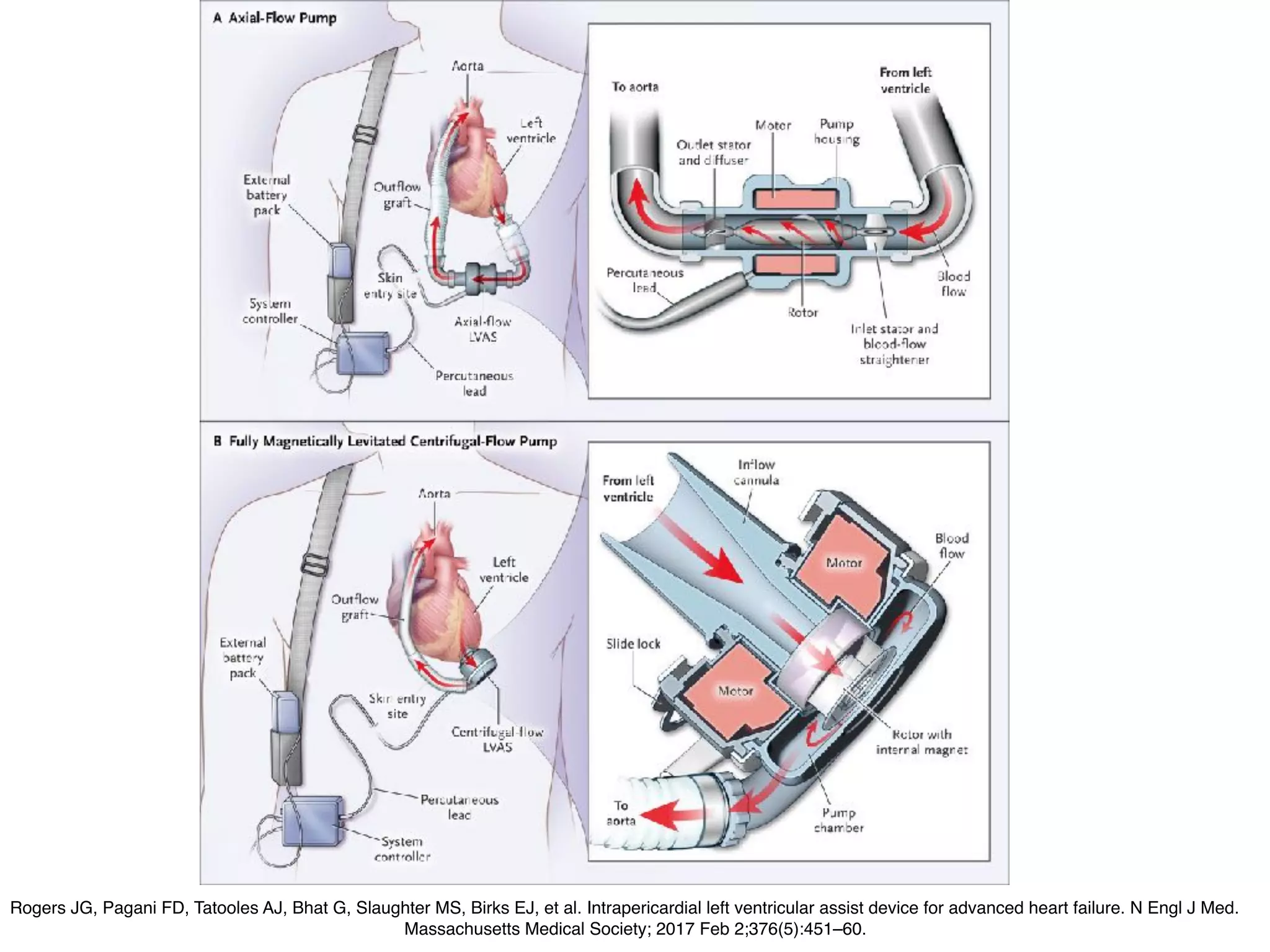 Ventricular assist devices | PDF