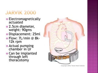 Jarvik 2000 Lvad
