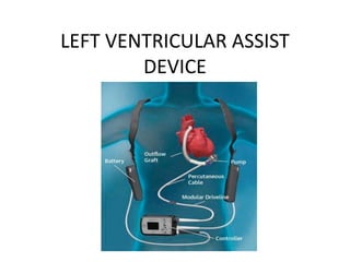 LVAD.pptx