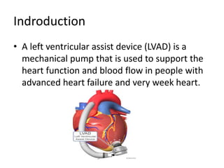 LVAD.pptx