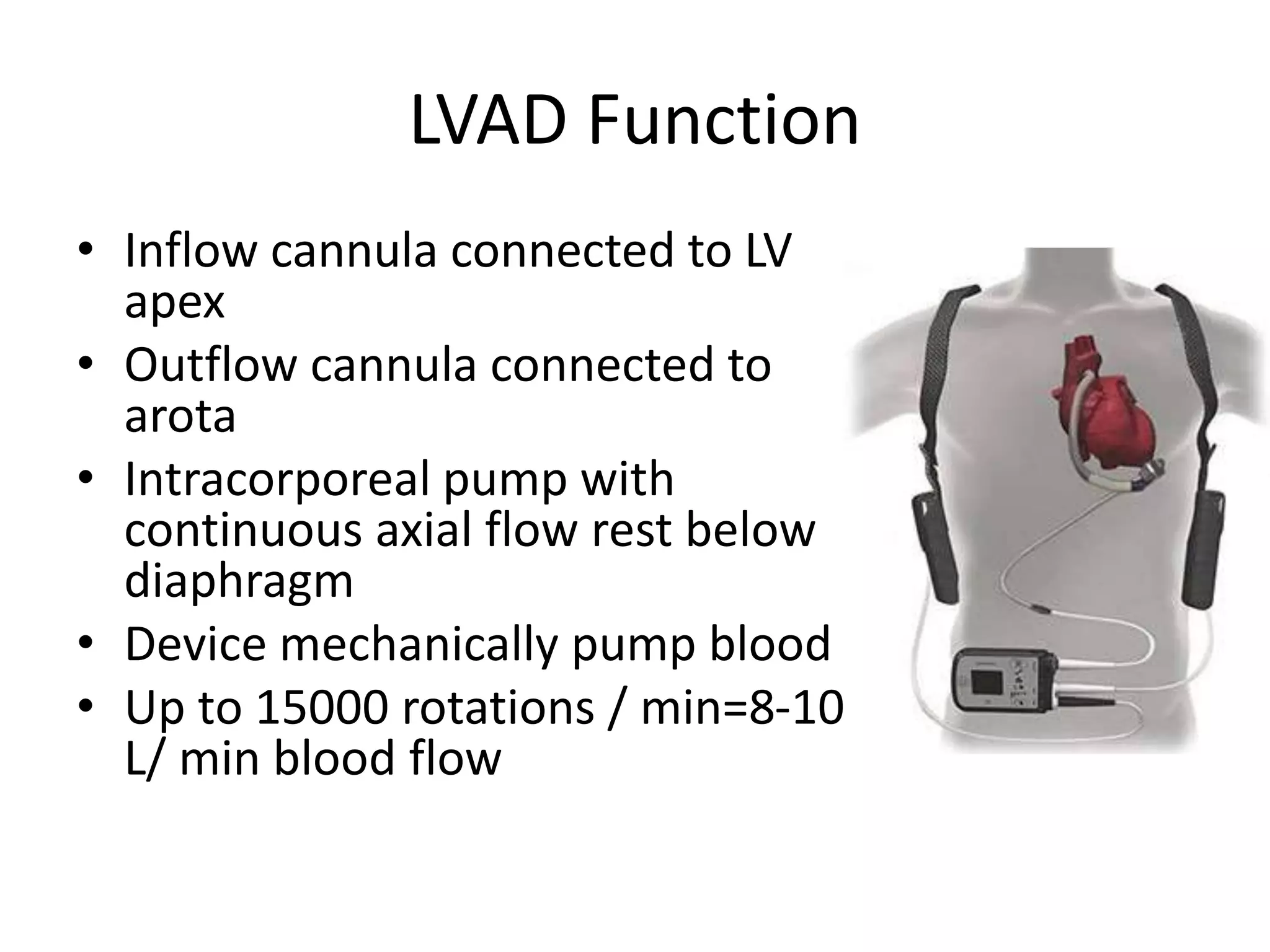 LVAD.pptx