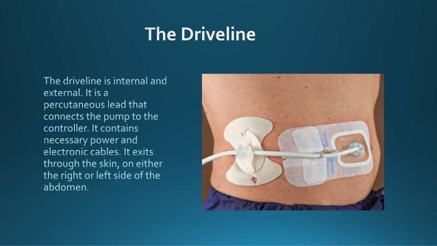 Lvn Procedures