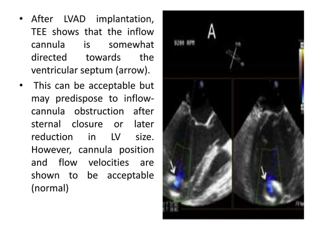 Lvad (left ventricular assist device) echo | PPTX