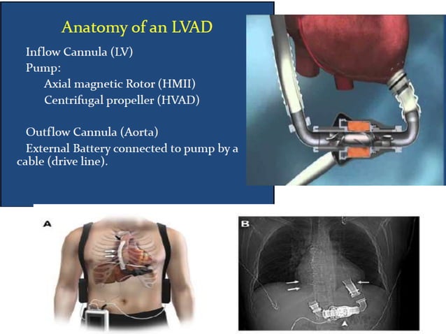 Lvad (left ventricular assist device) echo | PPTX