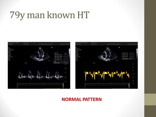 LV diastolic filling patterns – normal and impaired relaxation ...