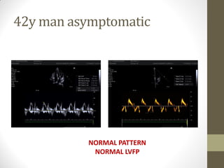 LV diastolic filling patterns – normal and impaired relaxation ...