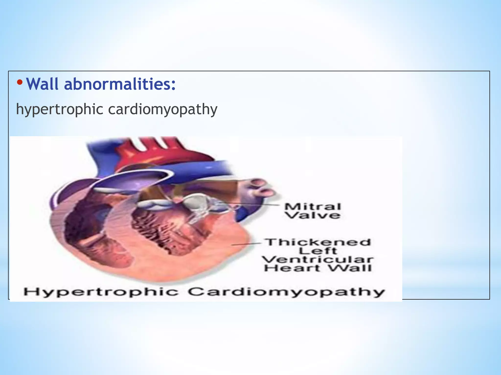 Left ventricular enlargement radiology | PPTX