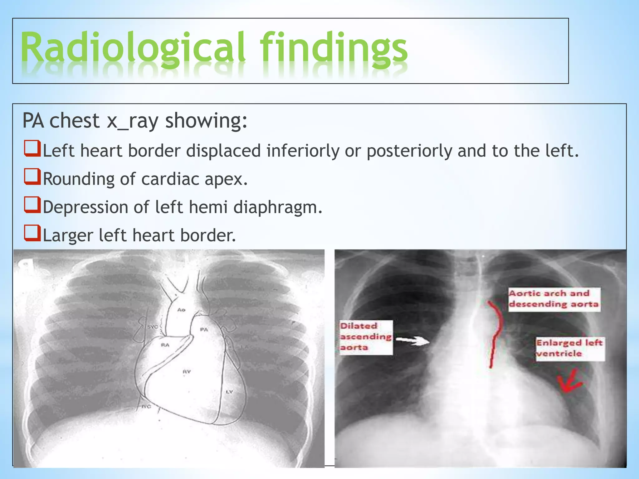 Left ventricular enlargement radiology | PPTX