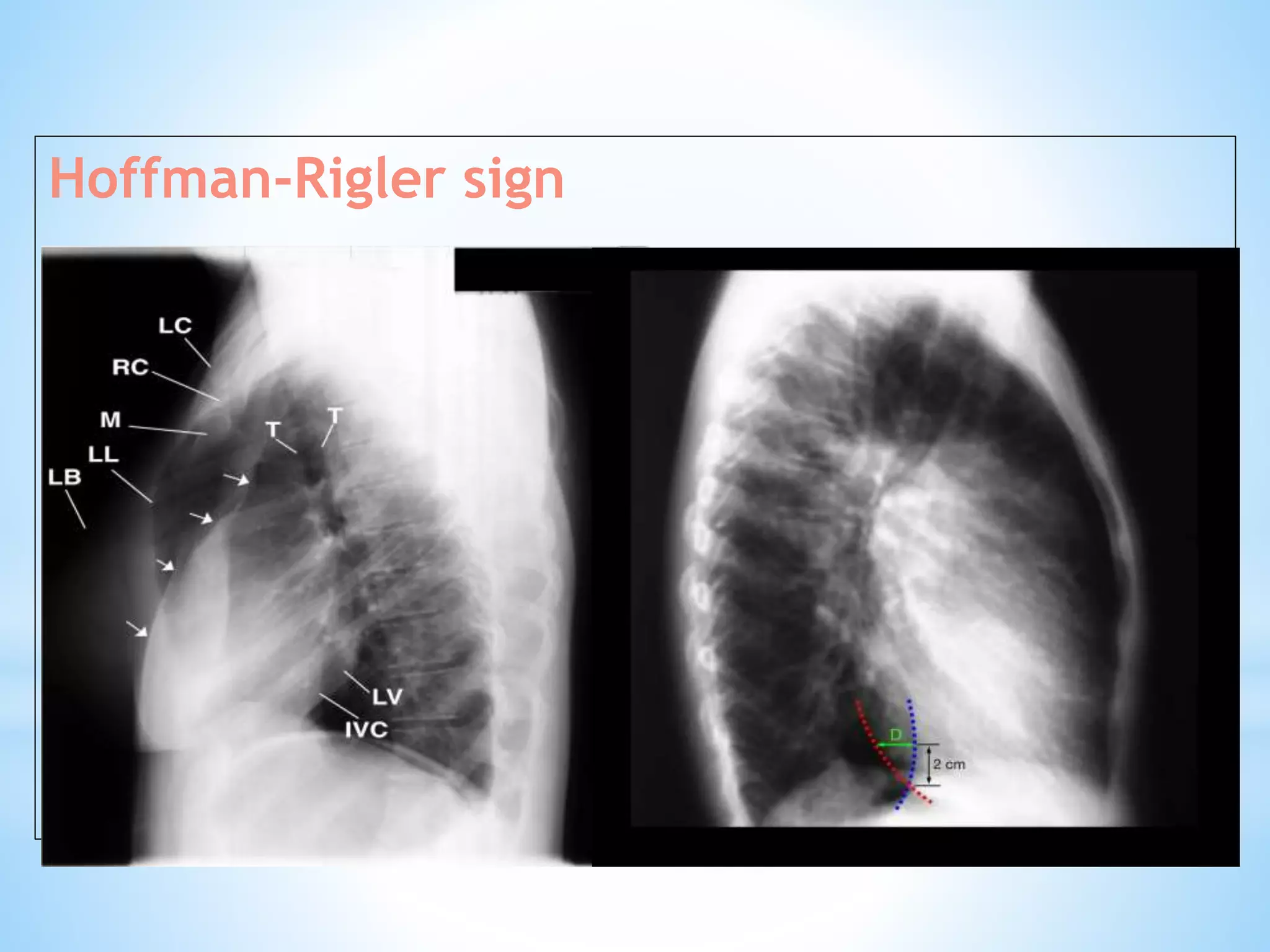 Left ventricular enlargement radiology | PPTX