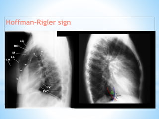 Left ventricular enlargement radiology | PPTX