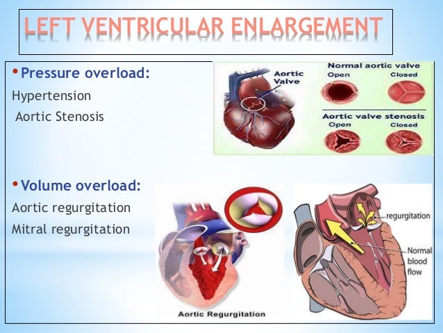 Left ventricular enlargement radiology