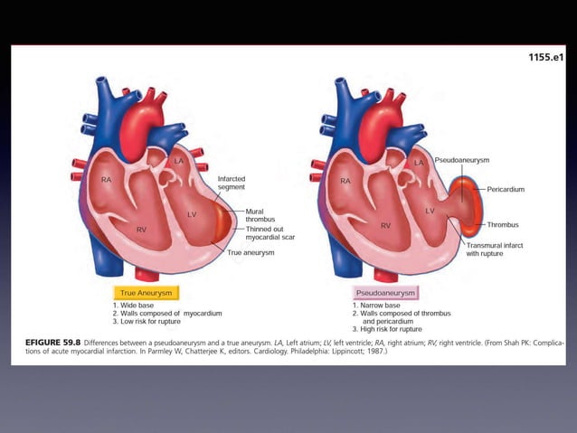 Lv free wall rupture | PPTX | Heart and Cardiovascular Diseases ...