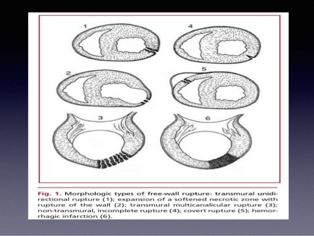 Lv free wall rupture