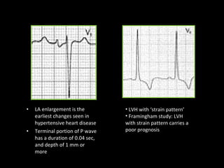 Lvh | PPT