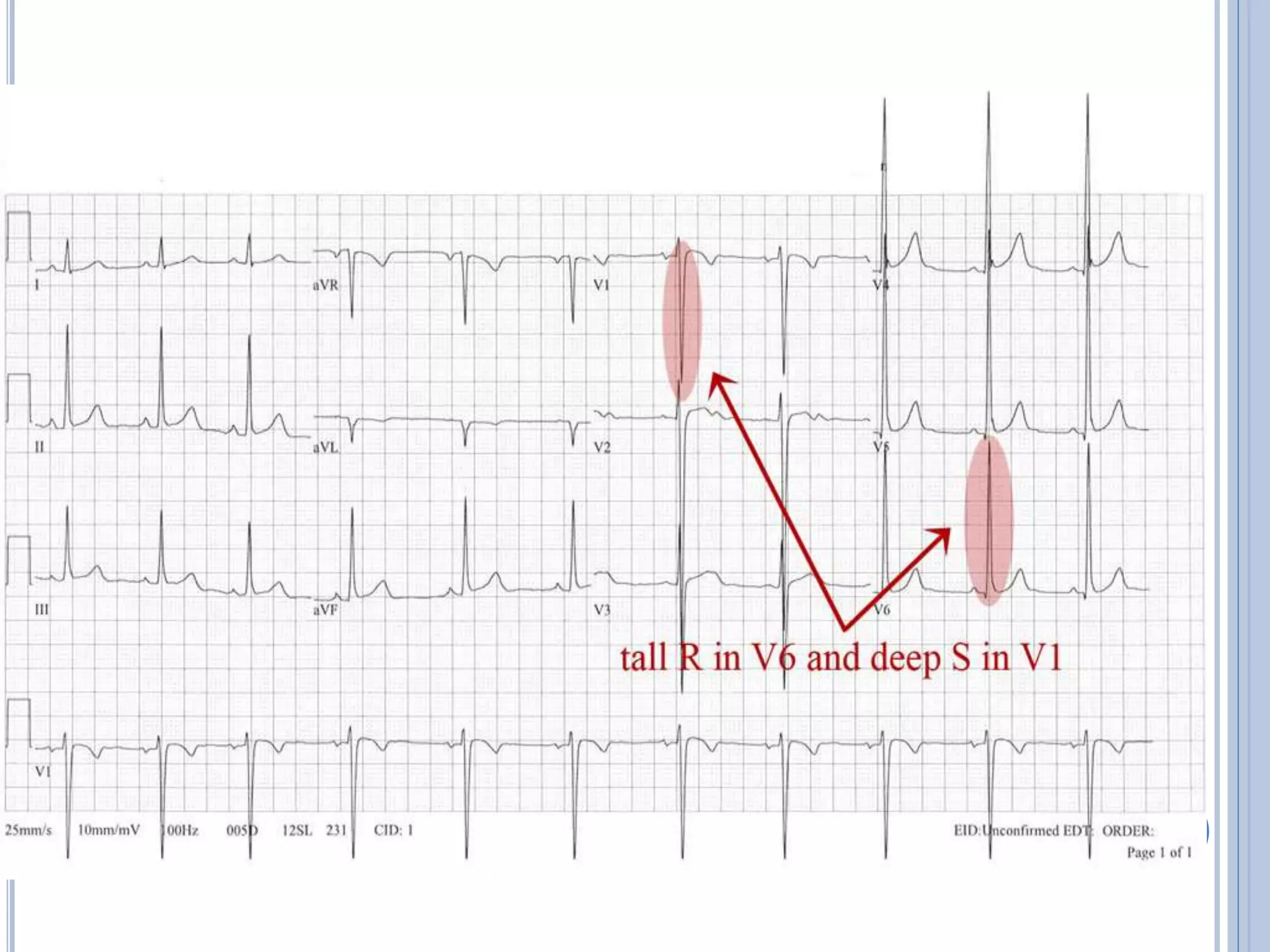 Lvh & rvh | PPTX | Heart and Cardiovascular Diseases | Diseases and ...