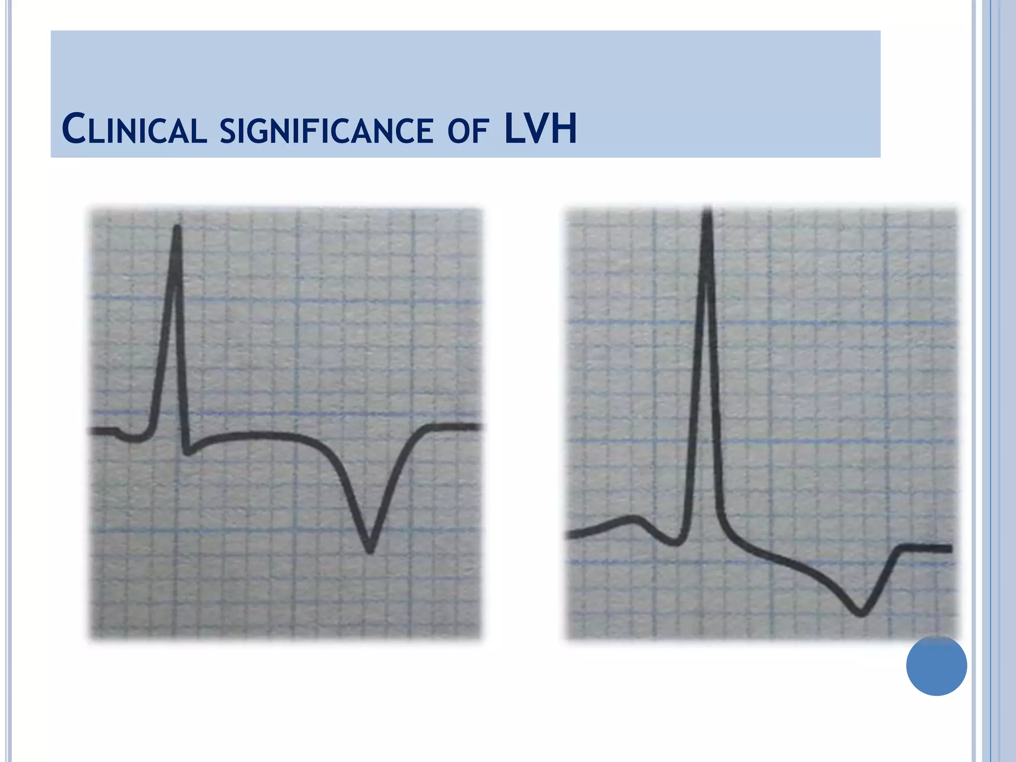 Lvh & rvh | PPTX