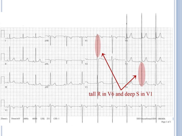 Lvh & rvh | PPTX | Heart and Cardiovascular Diseases | Diseases and ...