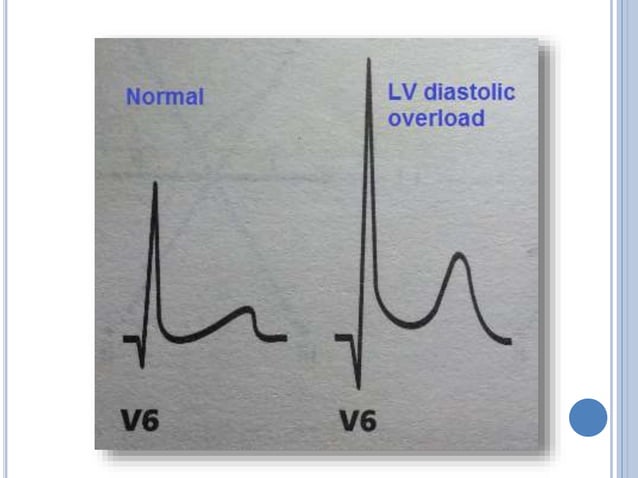 Lvh & rvh | PPTX | Heart and Cardiovascular Diseases | Diseases and ...