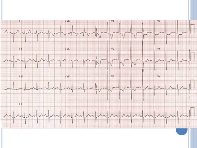 Lvh & rvh | PPTX | Heart and Cardiovascular Diseases | Diseases and ...