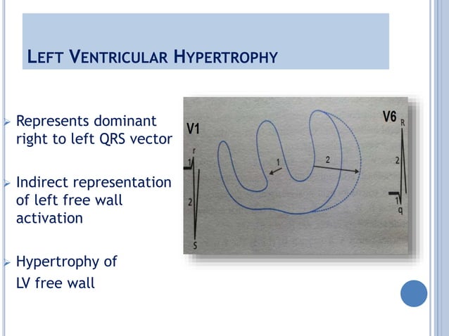 Lvh & rvh | PPTX | Heart and Cardiovascular Diseases | Diseases and ...