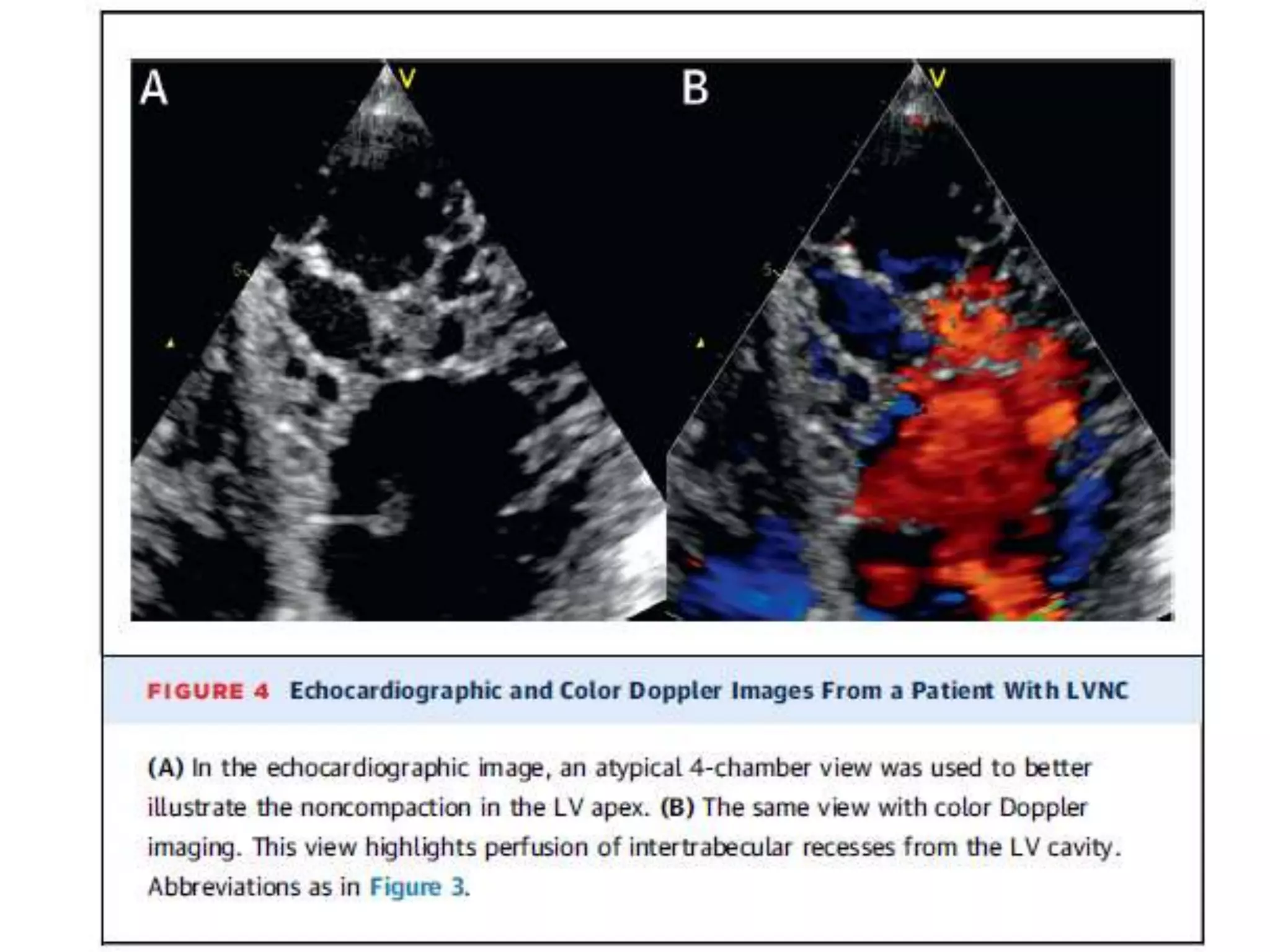 Left ventricular noncompaction | PPTX