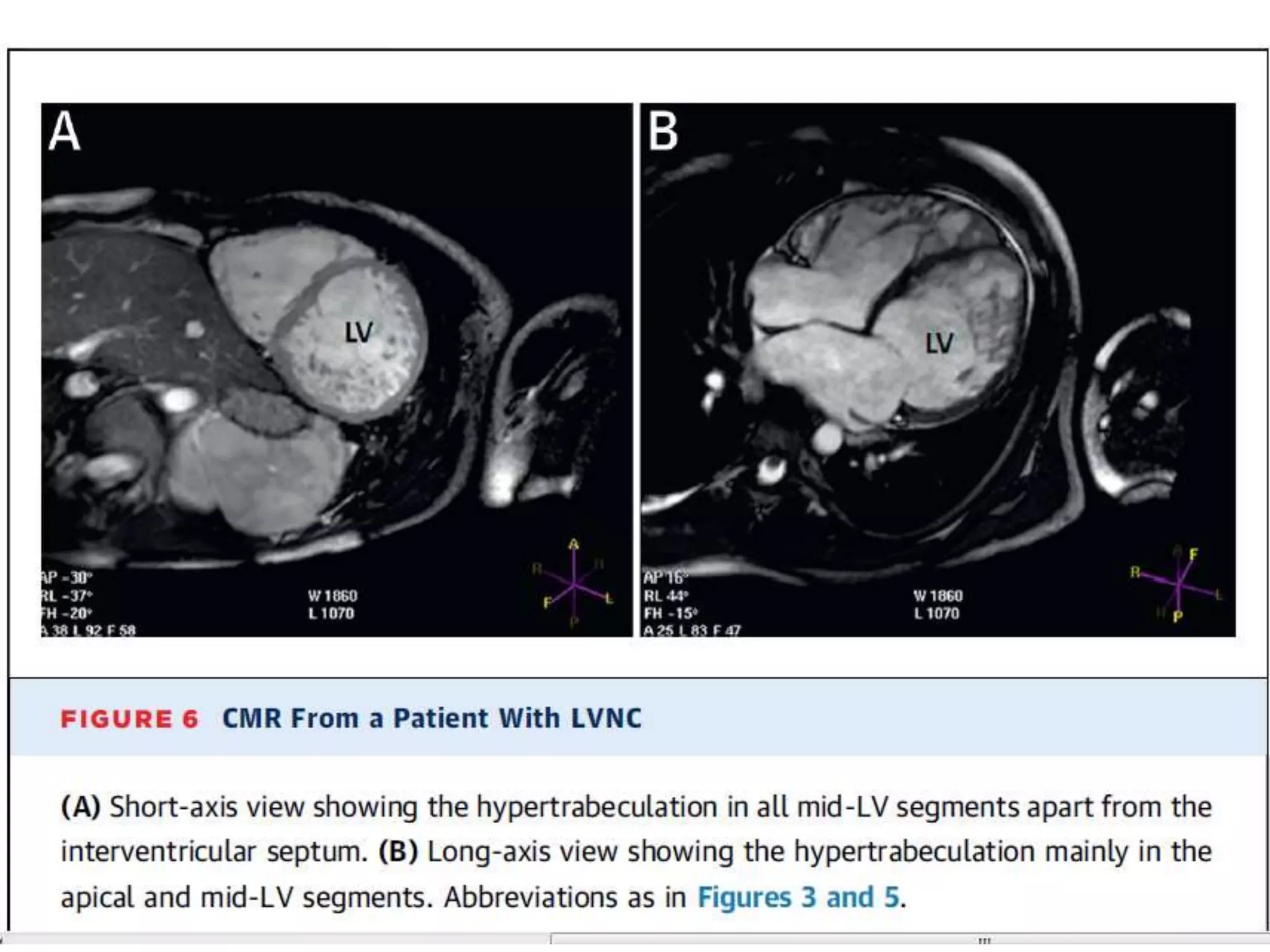 Left ventricular noncompaction | PPT